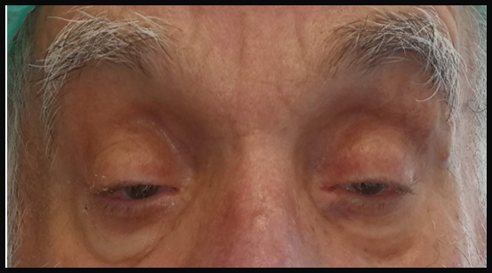 How is OPMD treated? - OPMD